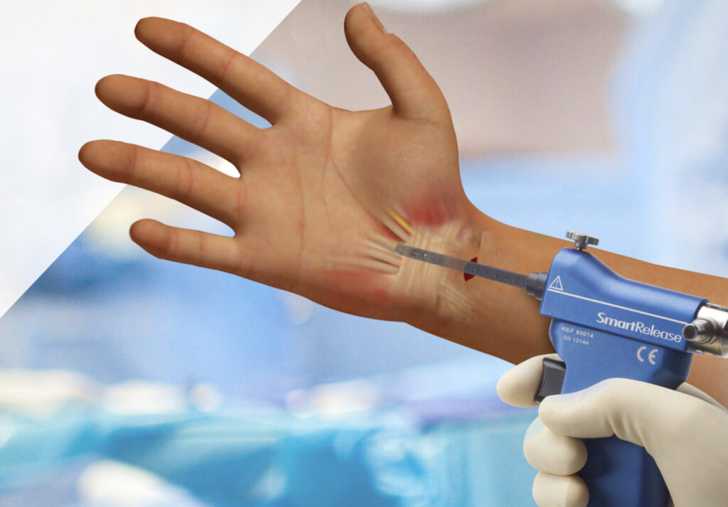 Tunnel Carpale - Patologia - Dott. Smeraglia Napoli